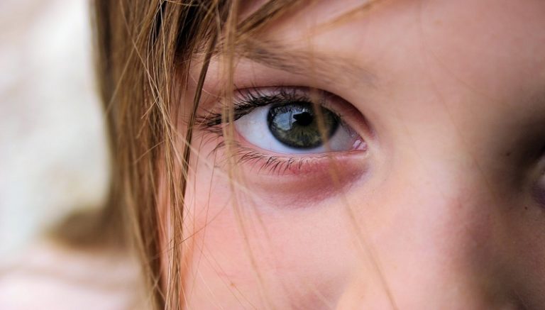Under Eye Skin Issues: Types, Causes And Treatments